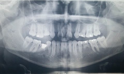 Agenesia dental: qué es, diagnóstico y tratamiento